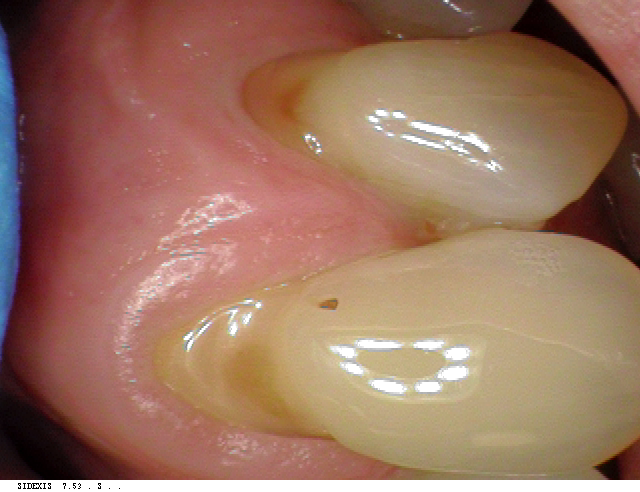 Pinhole Procedure After Care Instructions | St. Lawrence Dentistry