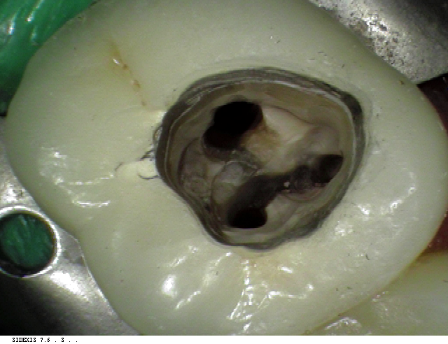 Root Canal Treatment Thru Dental Crowns St Lawrence Dentistry