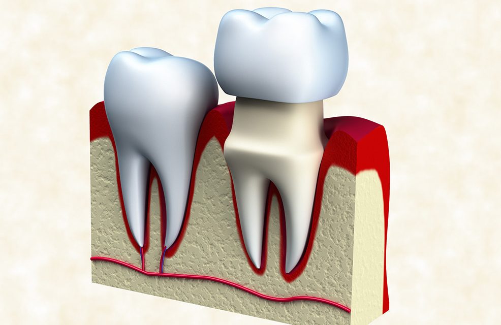 Root Canal Thru Crowns | St. Lawrence Dentistry Root Canal Thru Crowns | St. Lawrence Dentistry