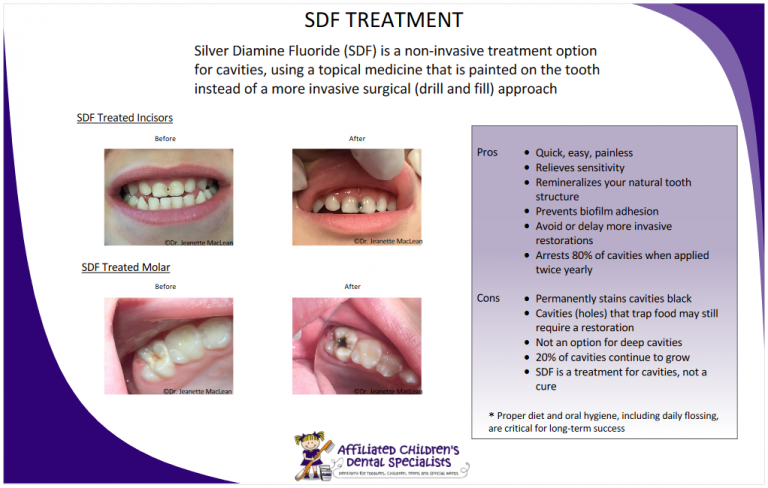 Treating Dental Decay with Silver Diamine Fluoride